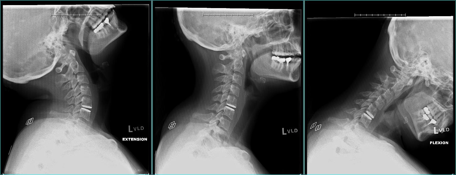 Cervical Disc Arthroplasty | Royal Spine Surgery