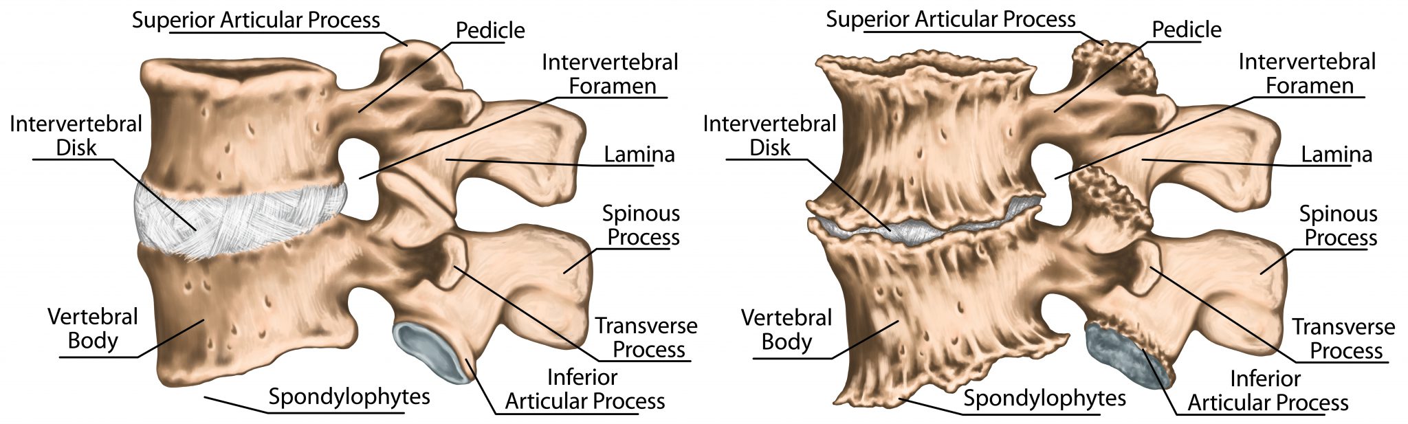 When Is Spinal Fusion Used? - Royal Spine Surgery